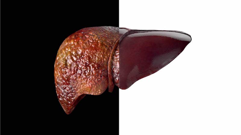 Hígado graso, pandemia silenciosa en América Latina